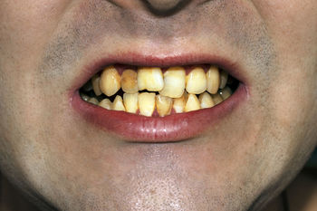 The Effect of Smoking on Your Gums and Teeth